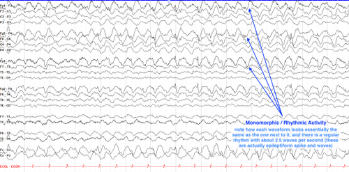 Eeg Terminology And Waveforms